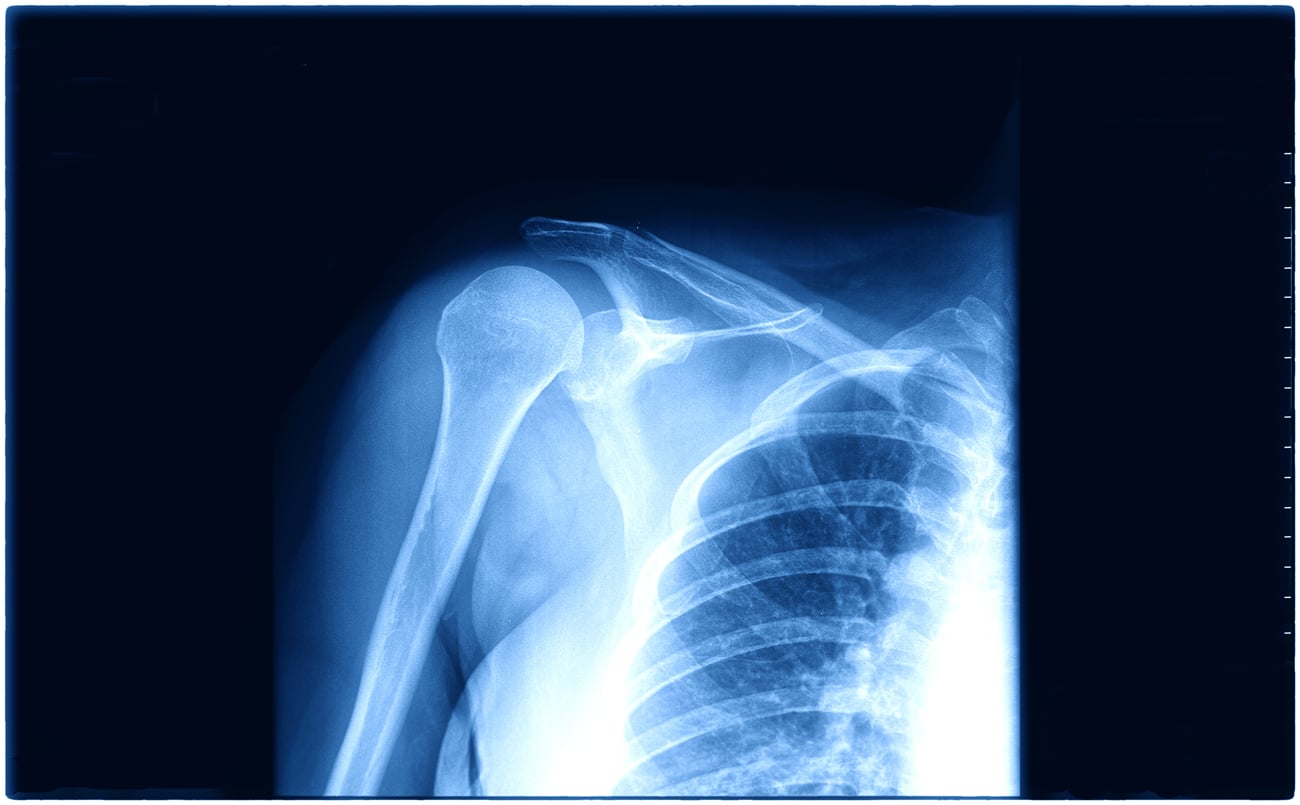 Appleton Shoulder Injury Lawyers | 🏆 Top Rated